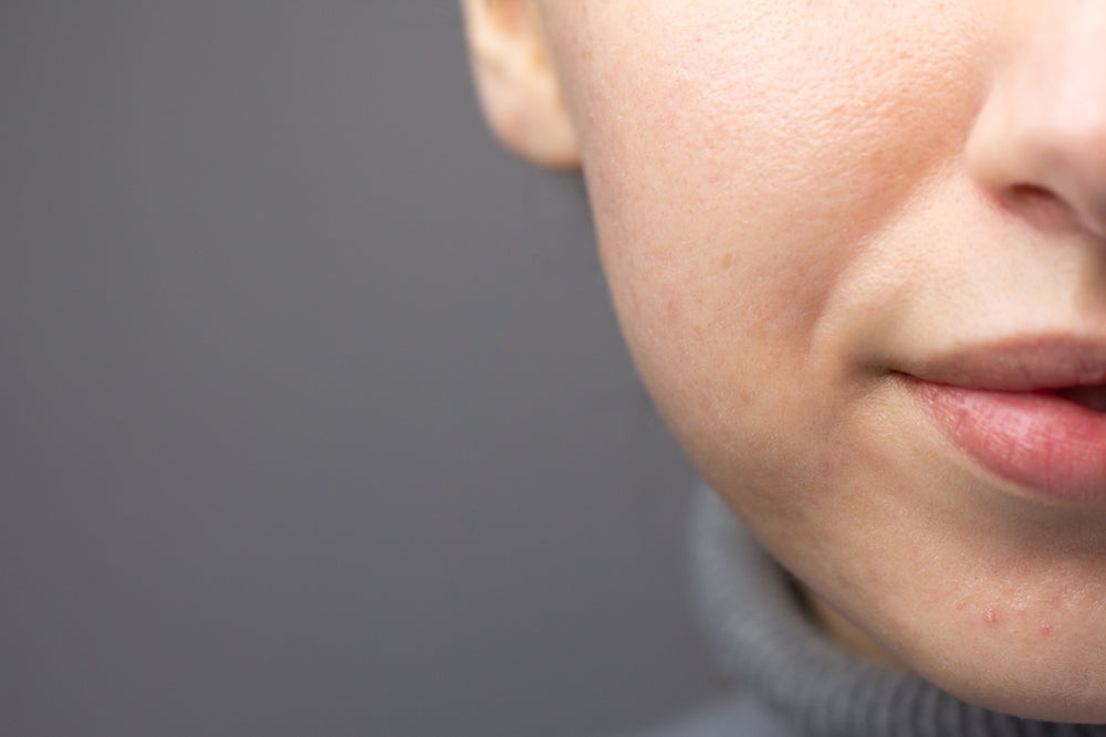 Pcos Before And After Acne